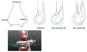Elbow lateral view – Tools for RadTech