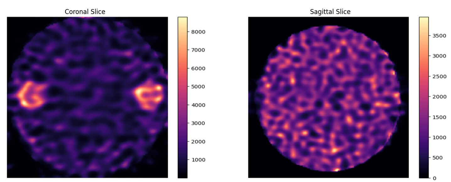 SIMINDの使い方3 ～PyTomographyによる再構成 OSEM & OSMAPOSL ＆ BSREM～｜Tools for RadTech